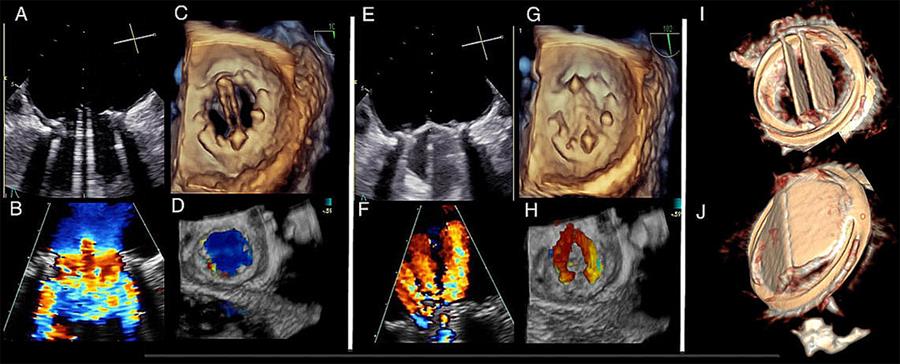 protesi valvolari cardiache - il Giornale di Salerno .it